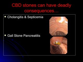 Management of bile duct stones | PPT