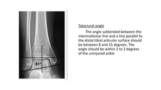 MANAGEMENT OF BIMALLEOUS FRACTURE .pptx