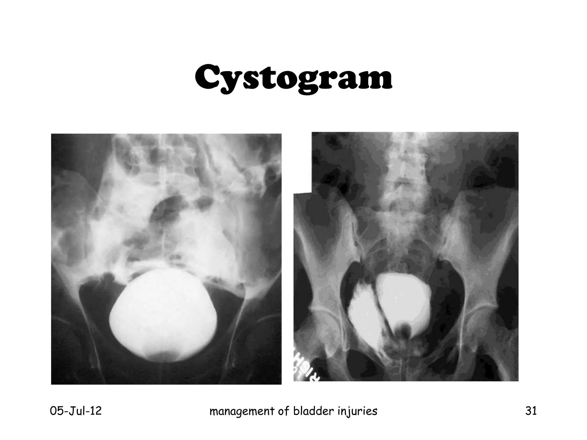 Management of bladder injuries dr aroju | PPTX