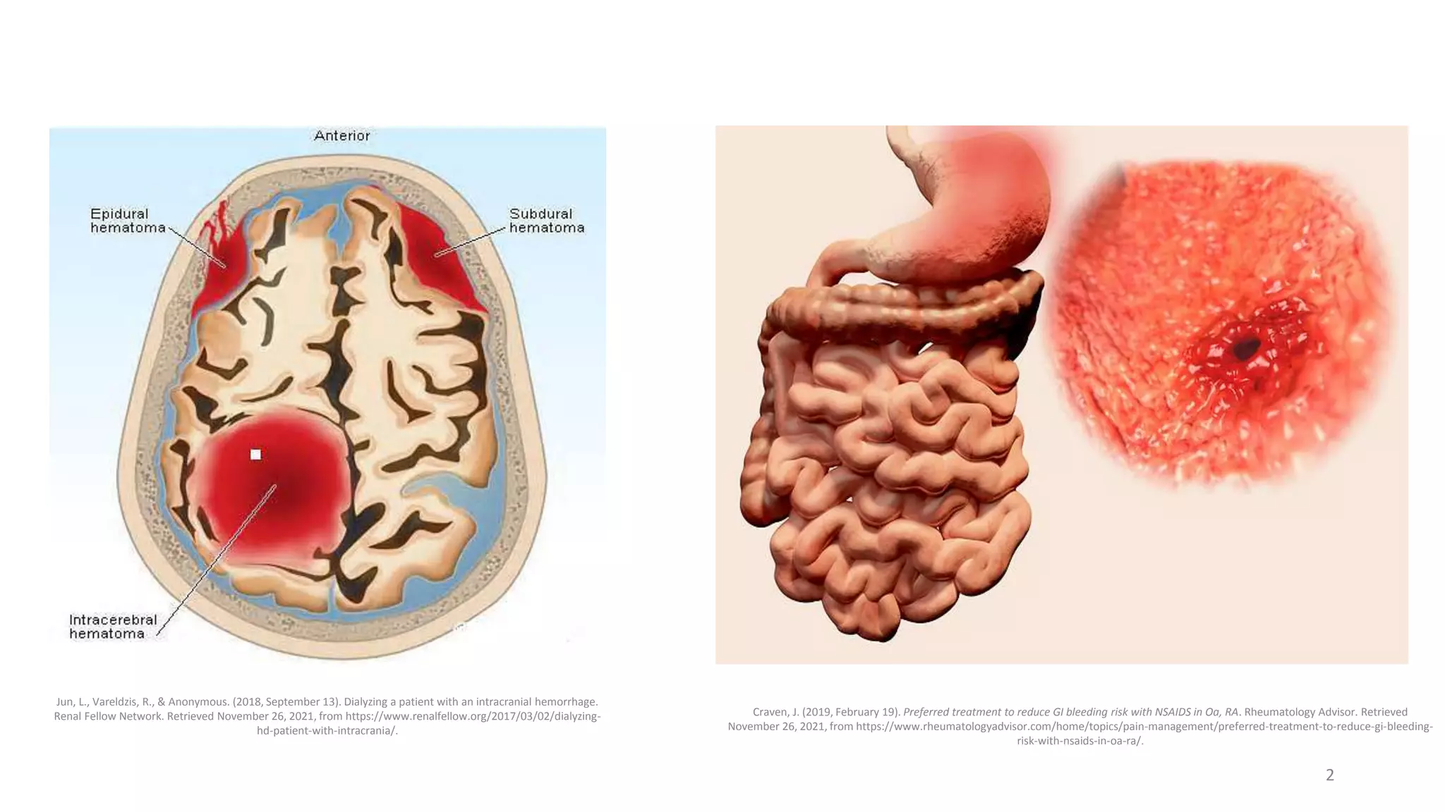 Management of bleeding in patients receiving DOAC.pptx