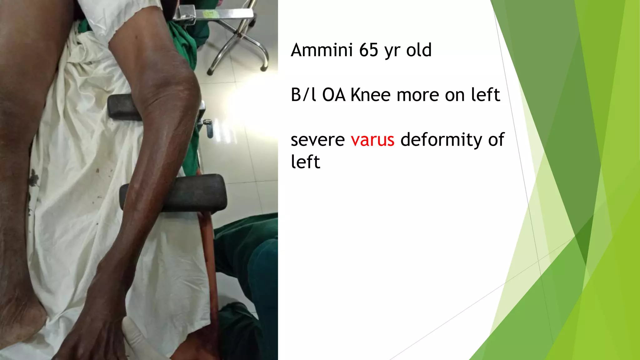 TOTAL KNEE REPLACEMENT (TKR) correction of varus and tibial bone defect ...
