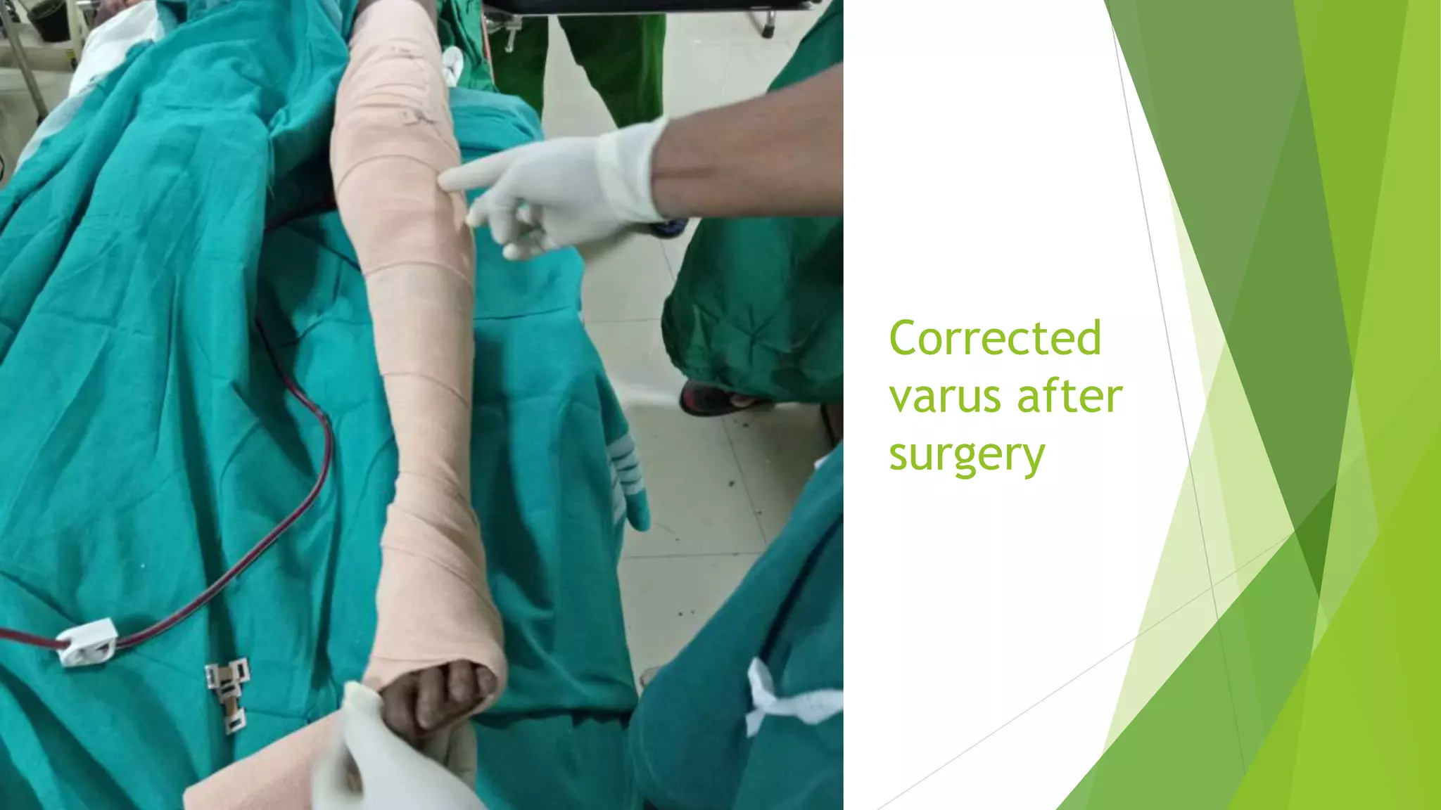 TOTAL KNEE REPLACEMENT (TKR) correction of varus and tibial bone defect ...