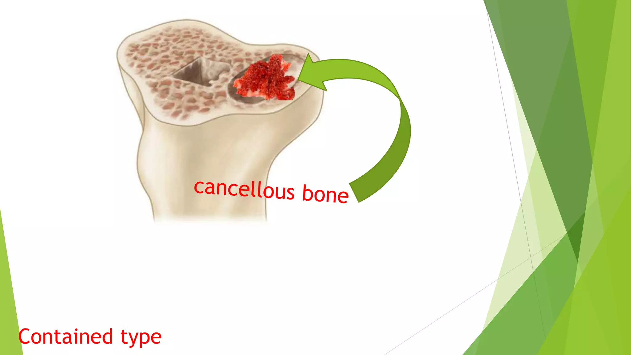 TOTAL KNEE REPLACEMENT (TKR) correction of varus and tibial bone defect ...