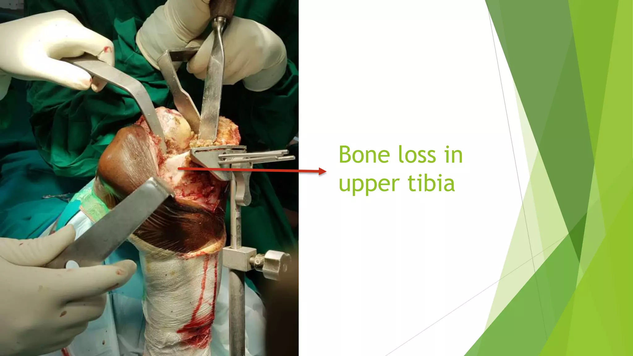 TOTAL KNEE REPLACEMENT (TKR) correction of varus and tibial bone defect ...