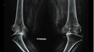 TOTAL KNEE REPLACEMENT (TKR) correction of varus and tibial bone defect ...