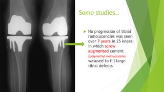 TOTAL KNEE REPLACEMENT (TKR) correction of varus and tibial bone defect ...