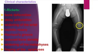 Management of bone disease in cystinosis | PPTX
