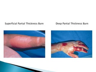 Management of burn | PPT