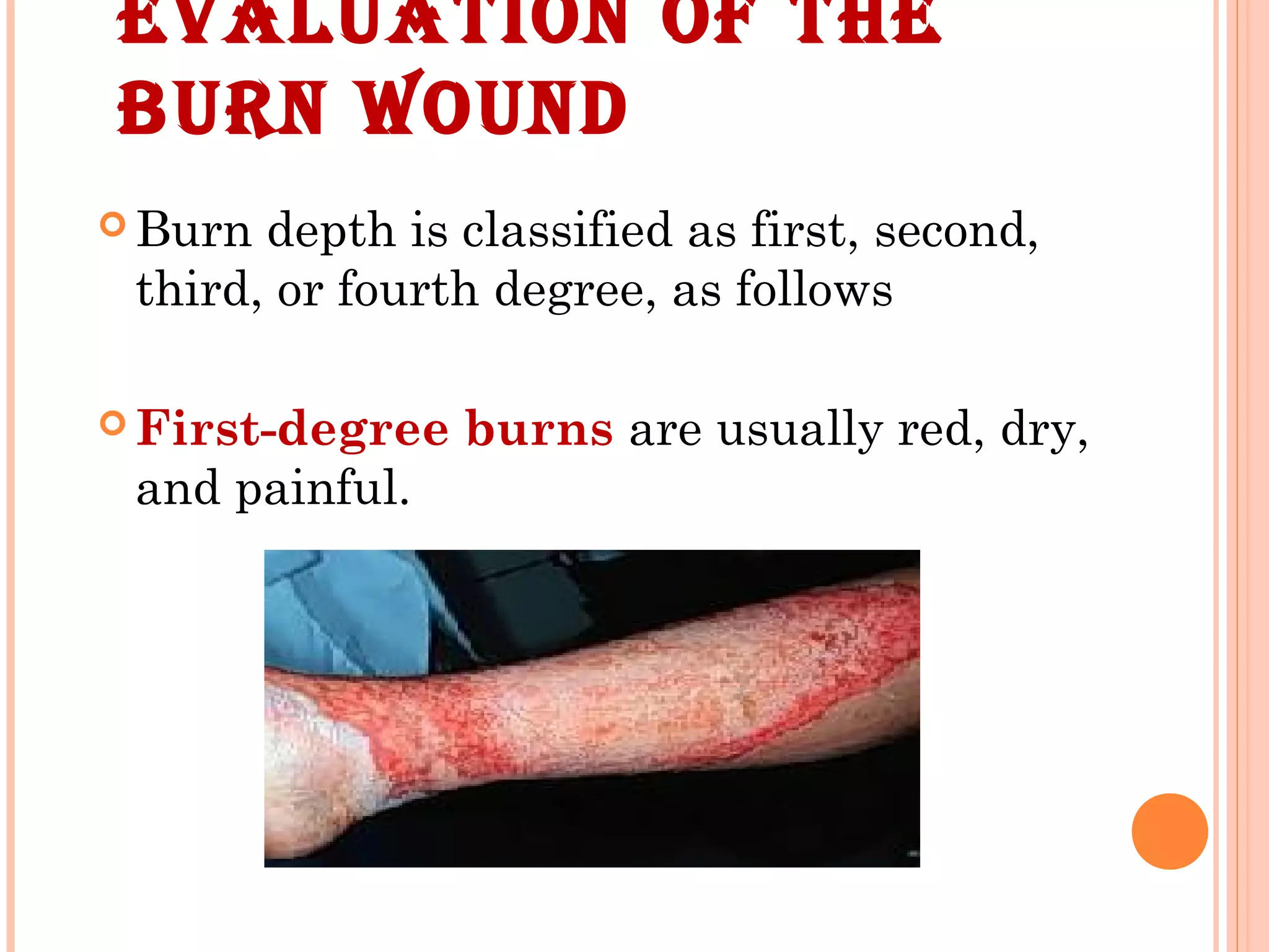 Management of burn in pediatric patients | PPT