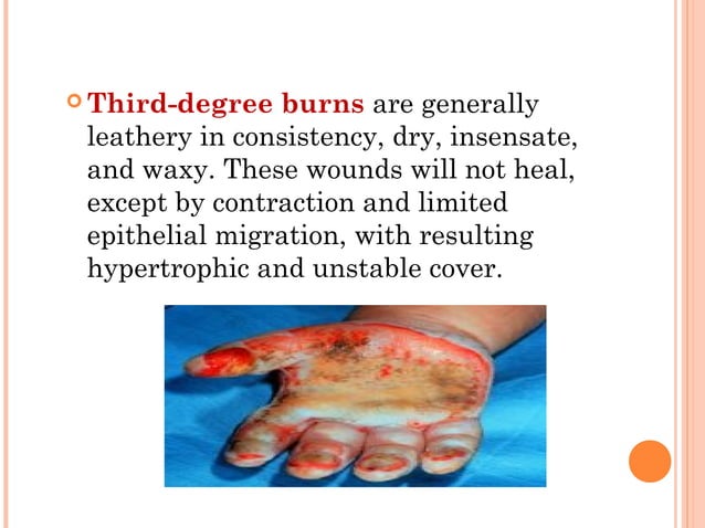 Management of burn in pediatric patients | PPT | First Aid | Injuries