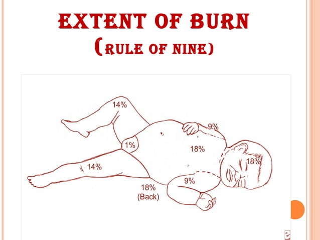 Management of burn in pediatric patients | PPT | First Aid | Injuries