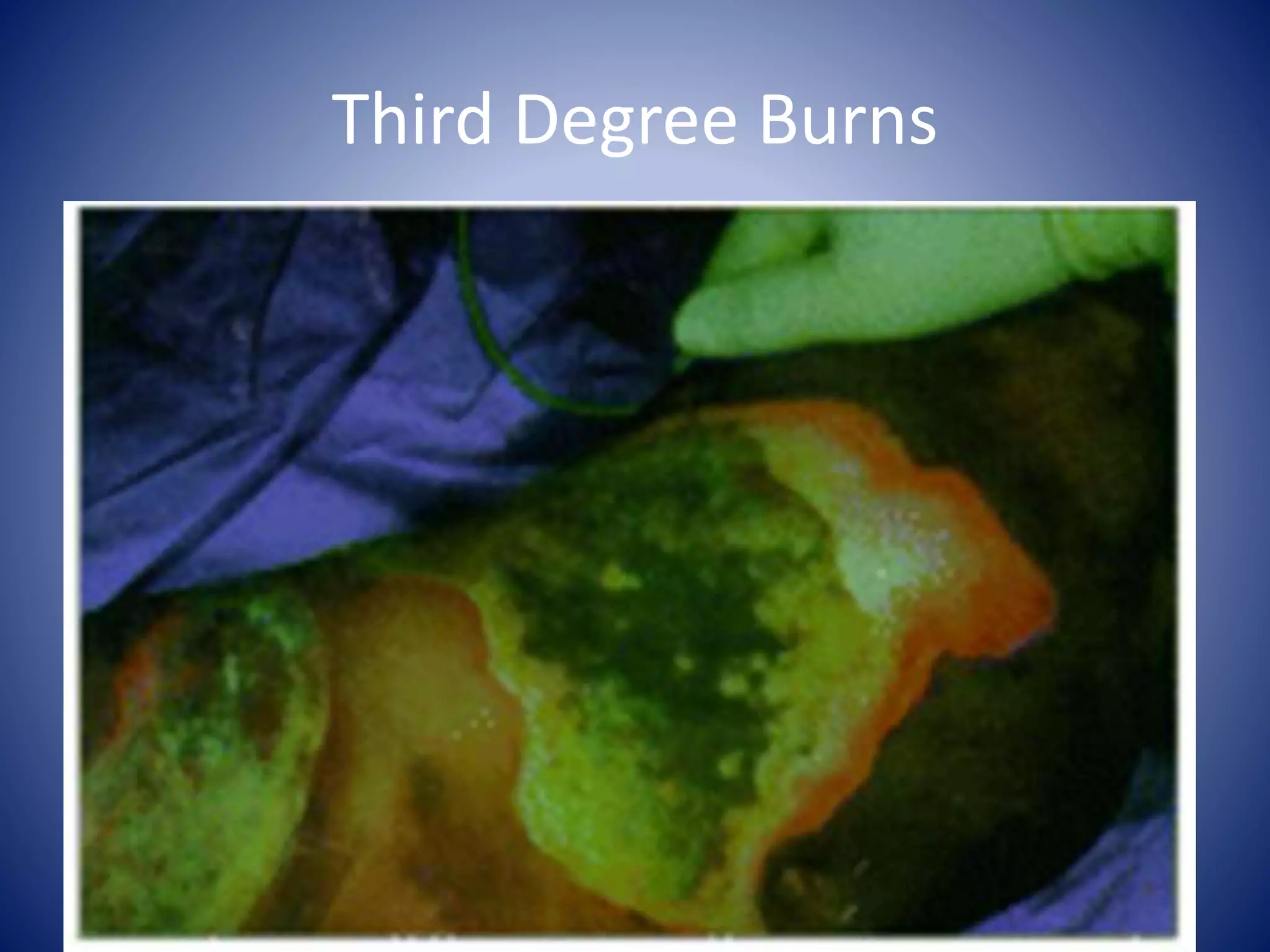 Management of burns | PPTX