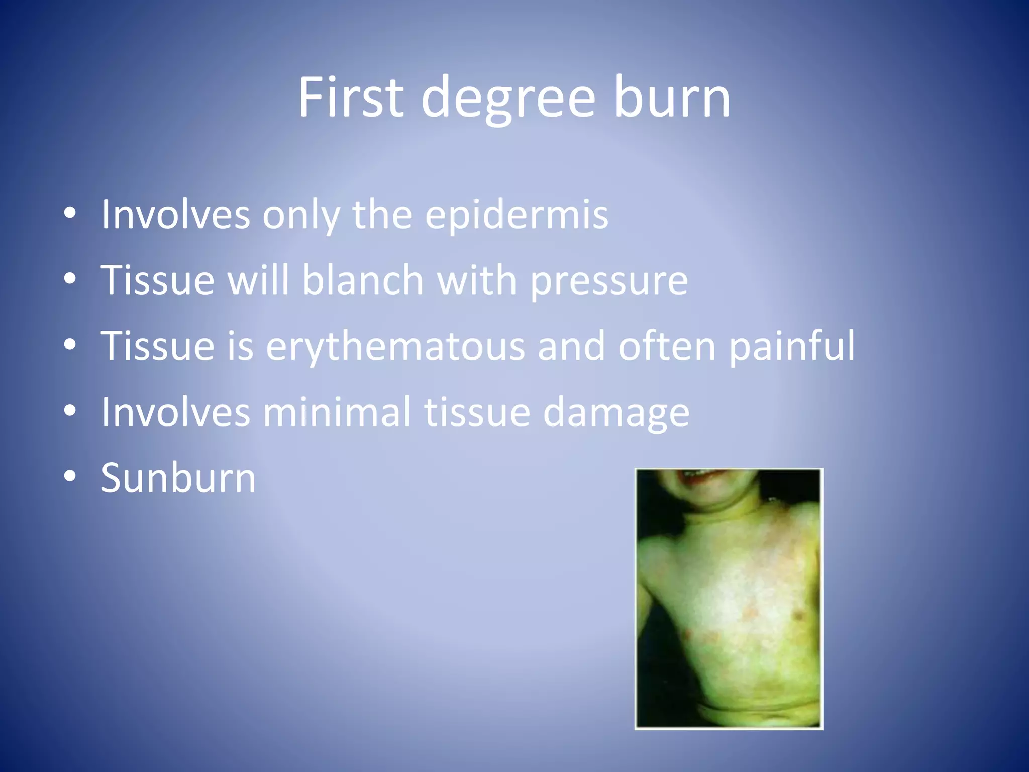 Management of burns | PPTX