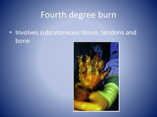 Management of burns | PPTX