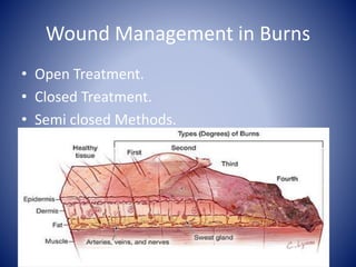 4th Degree Burn Diagram
