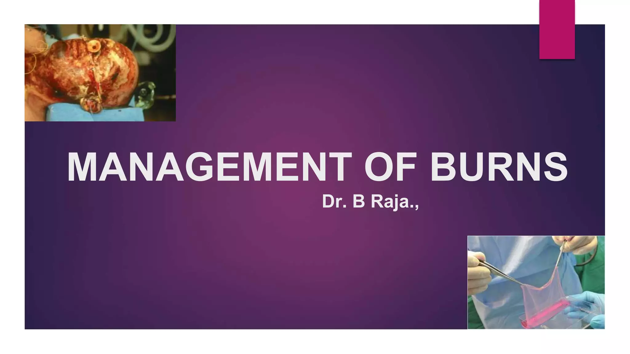Management of burns | PPTX