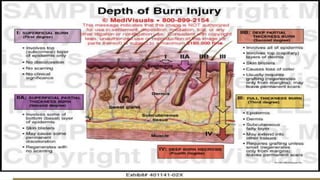 Management of burns | PPTX