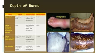 Management of burns | PPTX