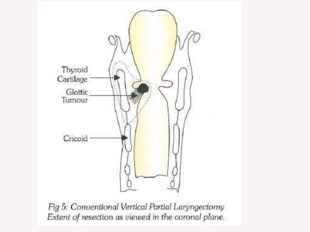 Management of ca. larynx | PPTX