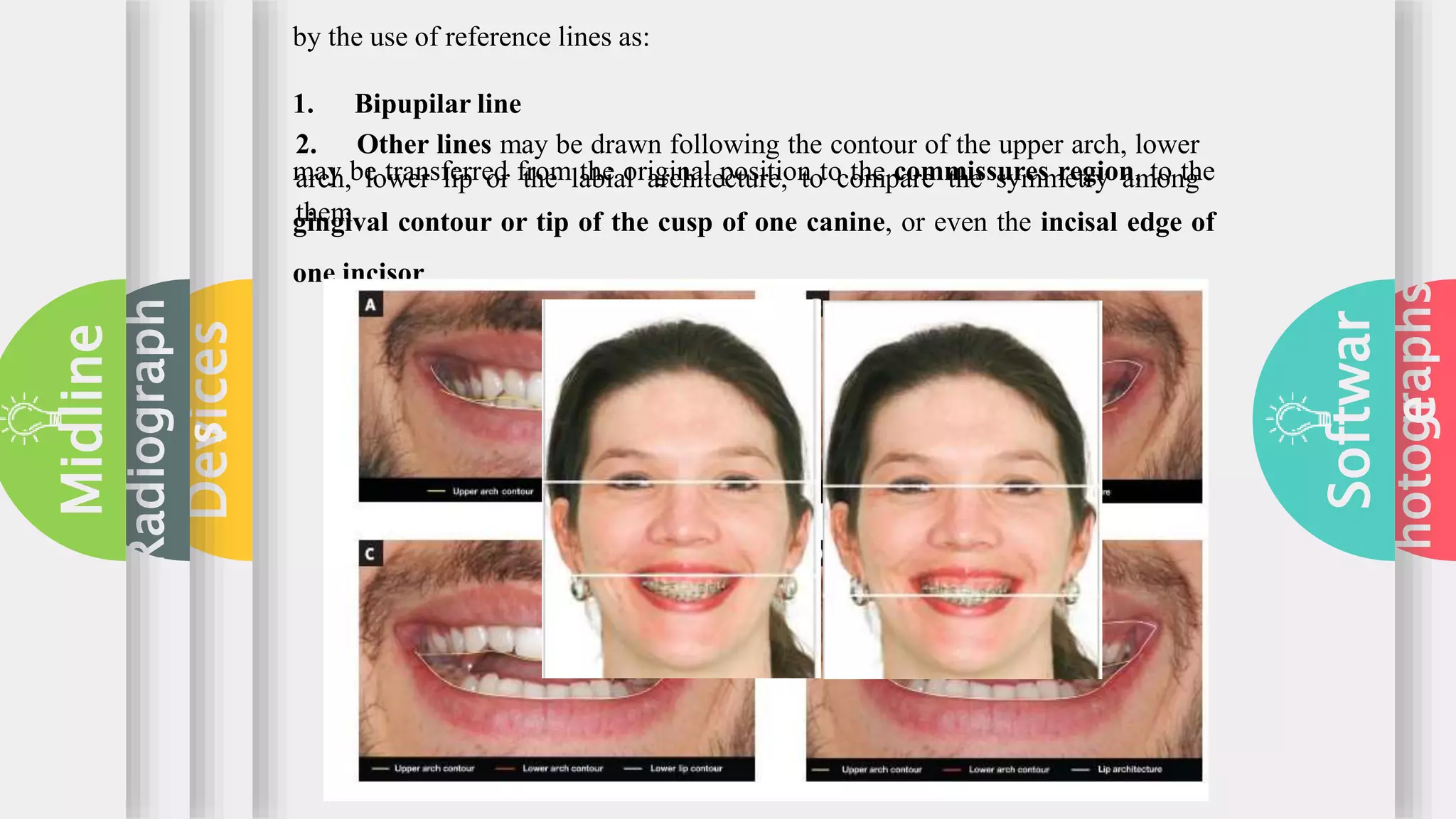Management of Canted Occlusal plane in Orthodontics.pptx