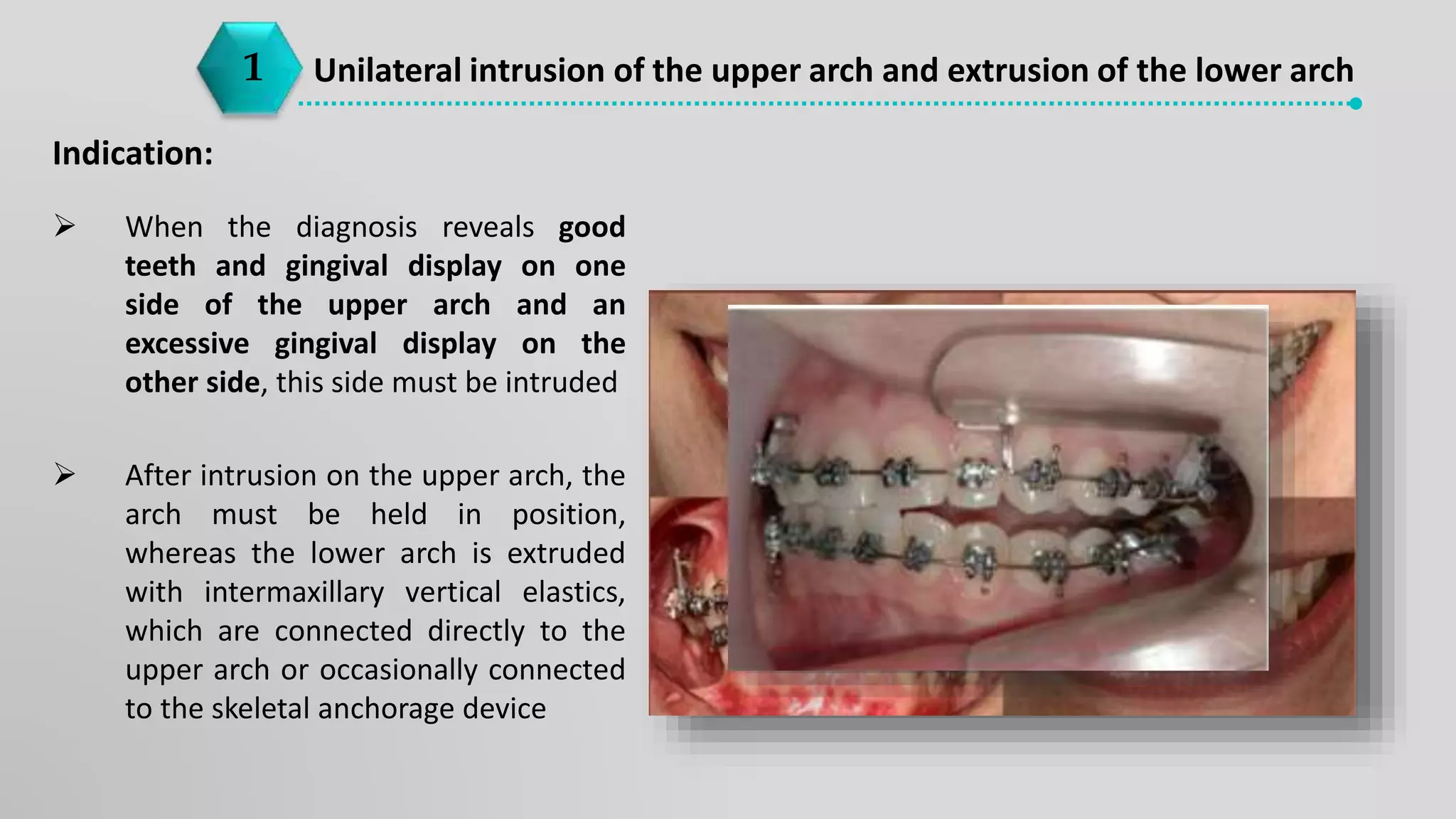 Management of Canted Occlusal plane in Orthodontics.pptx