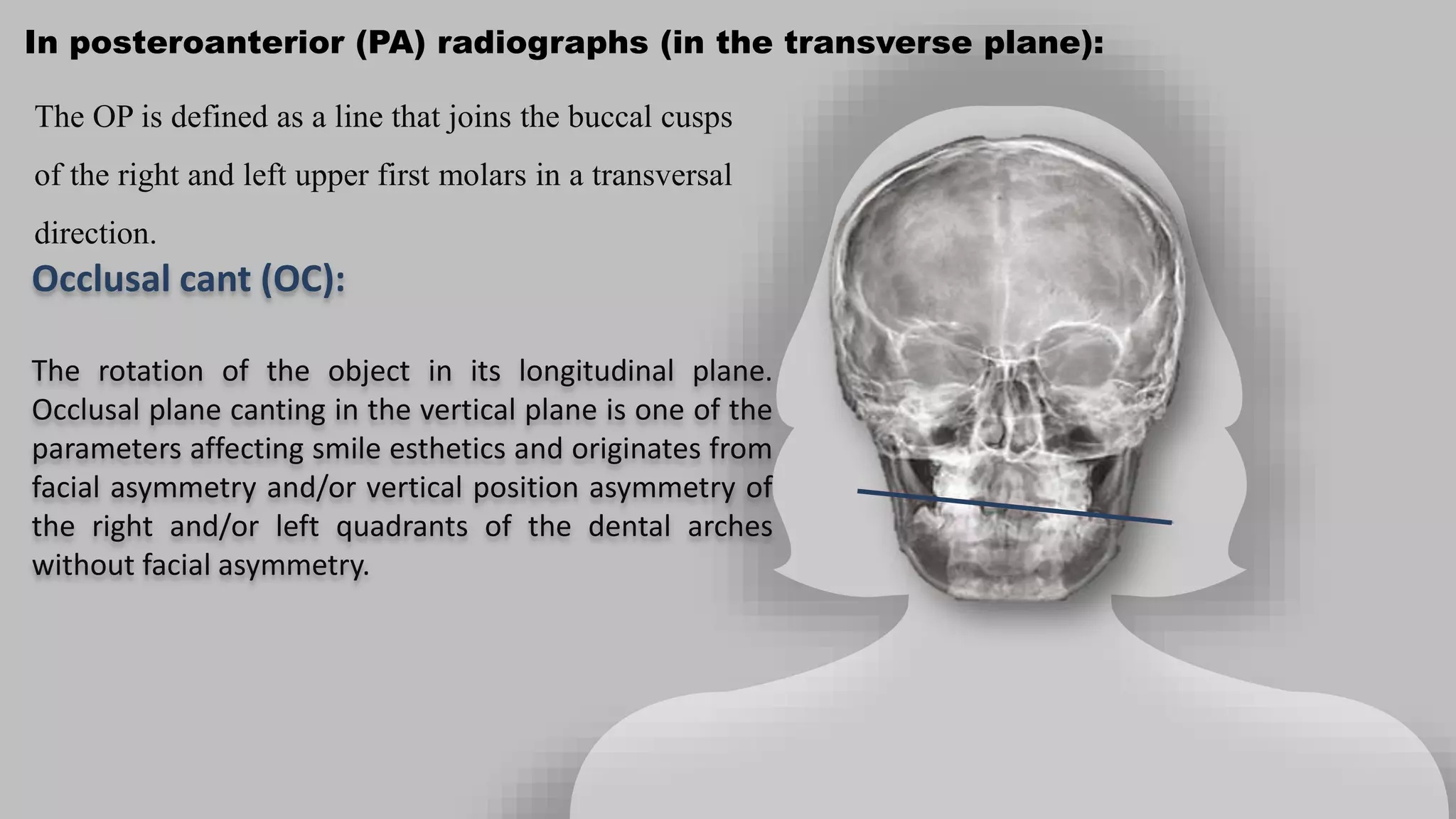 Management of Canted Occlusal plane in Orthodontics.pptx | Oral care ...