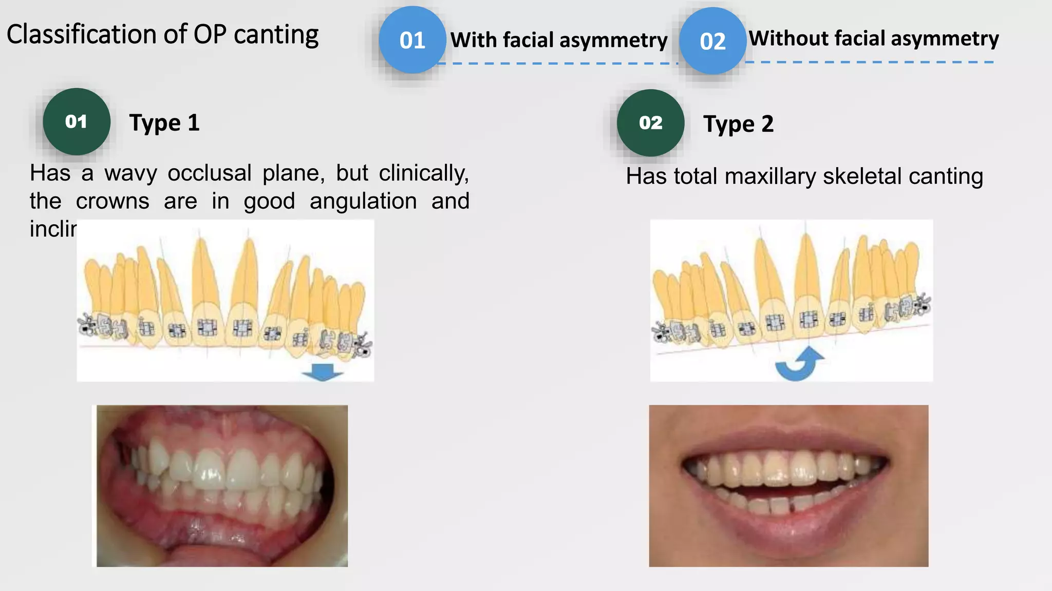 Management of Canted Occlusal plane in Orthodontics.pptx