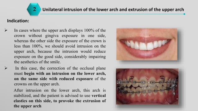 Management of Canted Occlusal plane in Orthodontics.pptx | Oral care ...