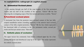 Management of Canted Occlusal plane in Orthodontics.pptx