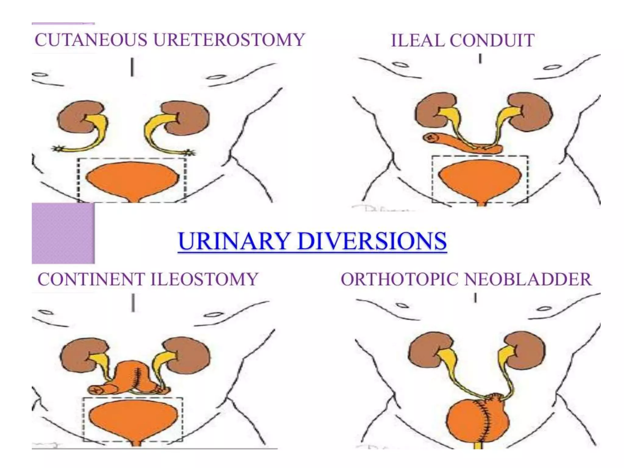Management of carcinomas of urinary bladder | PPTX