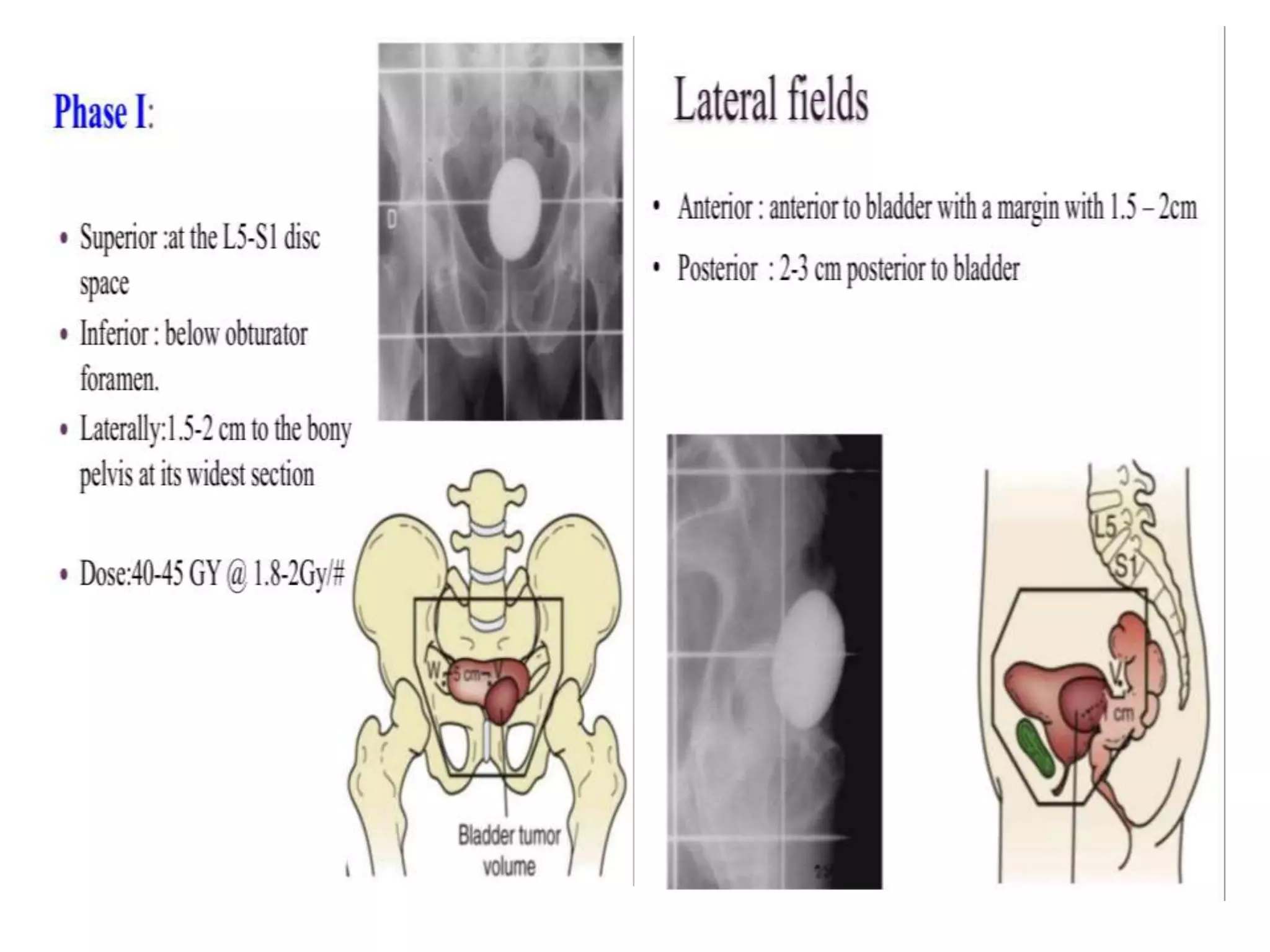 Management of carcinomas of urinary bladder | PPTX