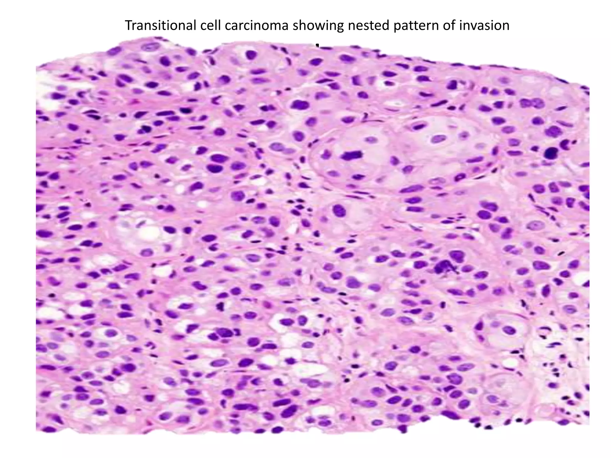 Management of carcinomas of urinary bladder | PPTX