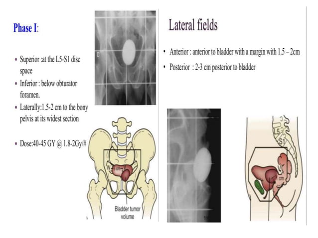 Management of carcinomas of urinary bladder | PPTX