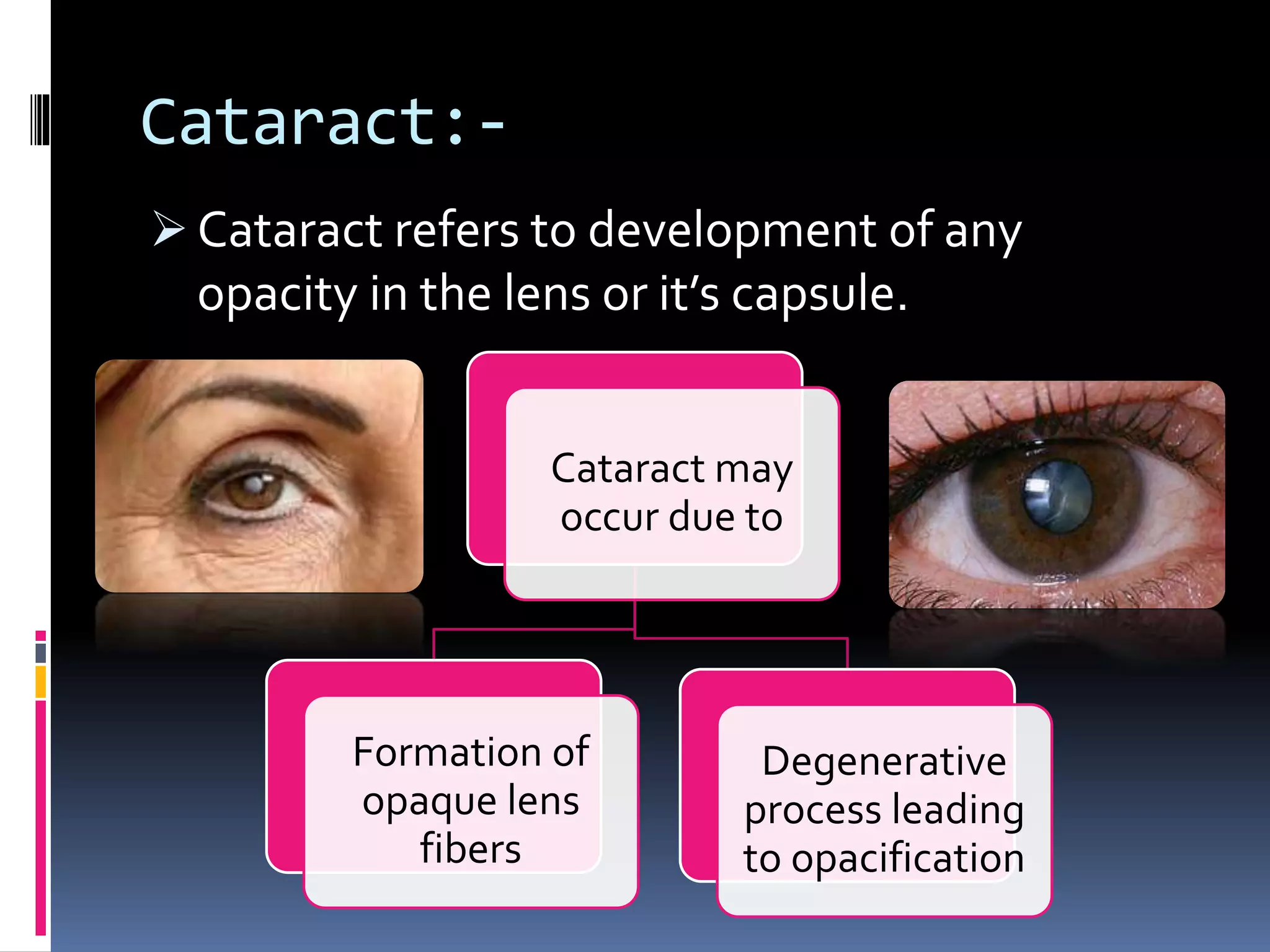 MANAGEMENT OF CATARACT.ppsx
