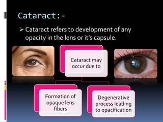 MANAGEMENT OF CATARACT.ppsx