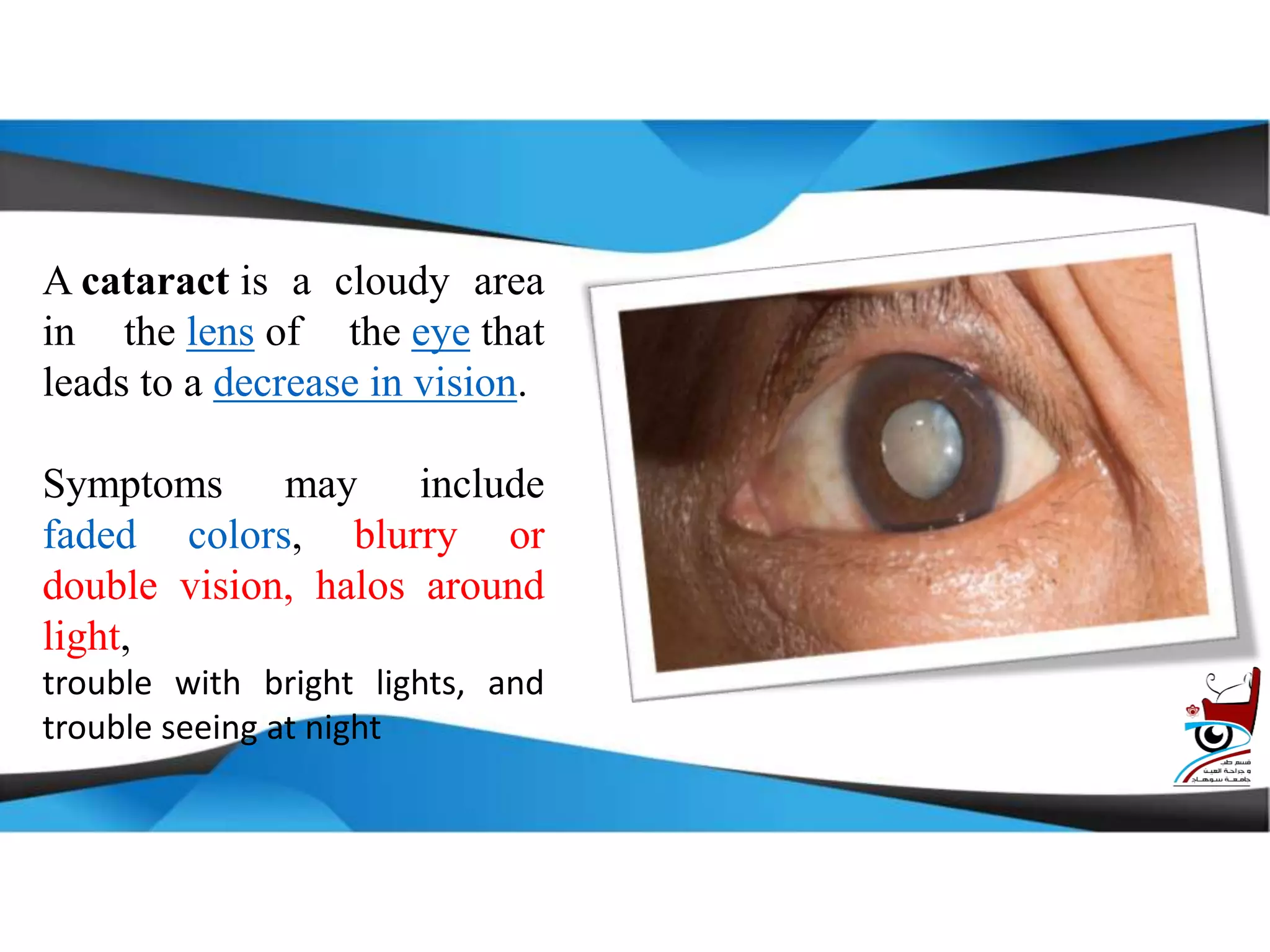 Management of Cataract.pptx