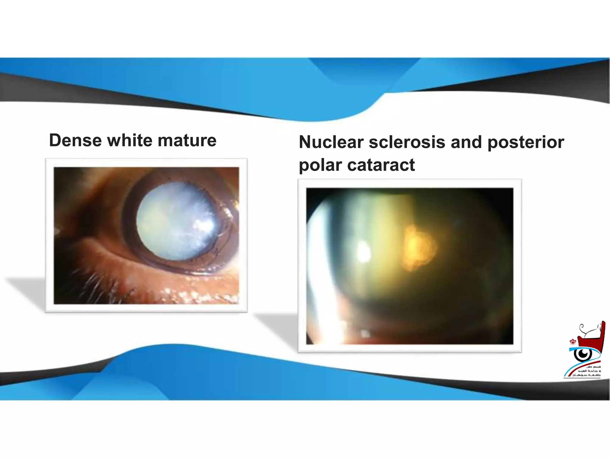 Management of Cataract.pptx
