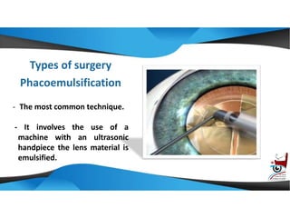 Management of Cataract.pptx