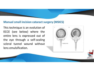 Management of Cataract.pptx