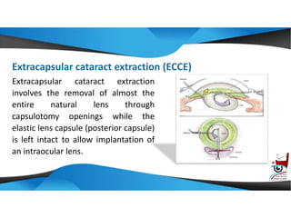 Management of Cataract.pptx