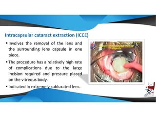 Management of Cataract.pptx