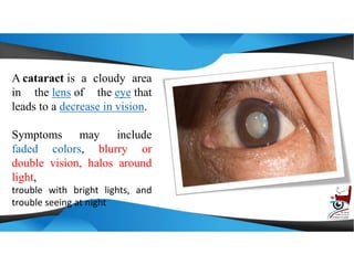 Management of Cataract.pptx
