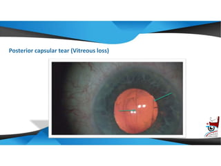 Management of Cataract.pptx