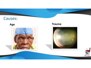Management of Cataract.pptx