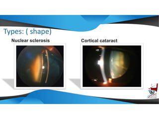 Management of Cataract.pptx