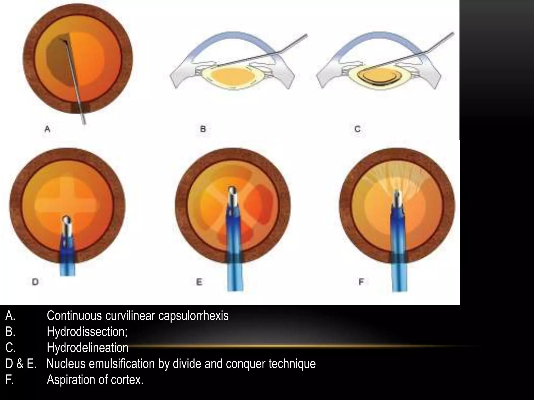 Management of Cataract | PPTX