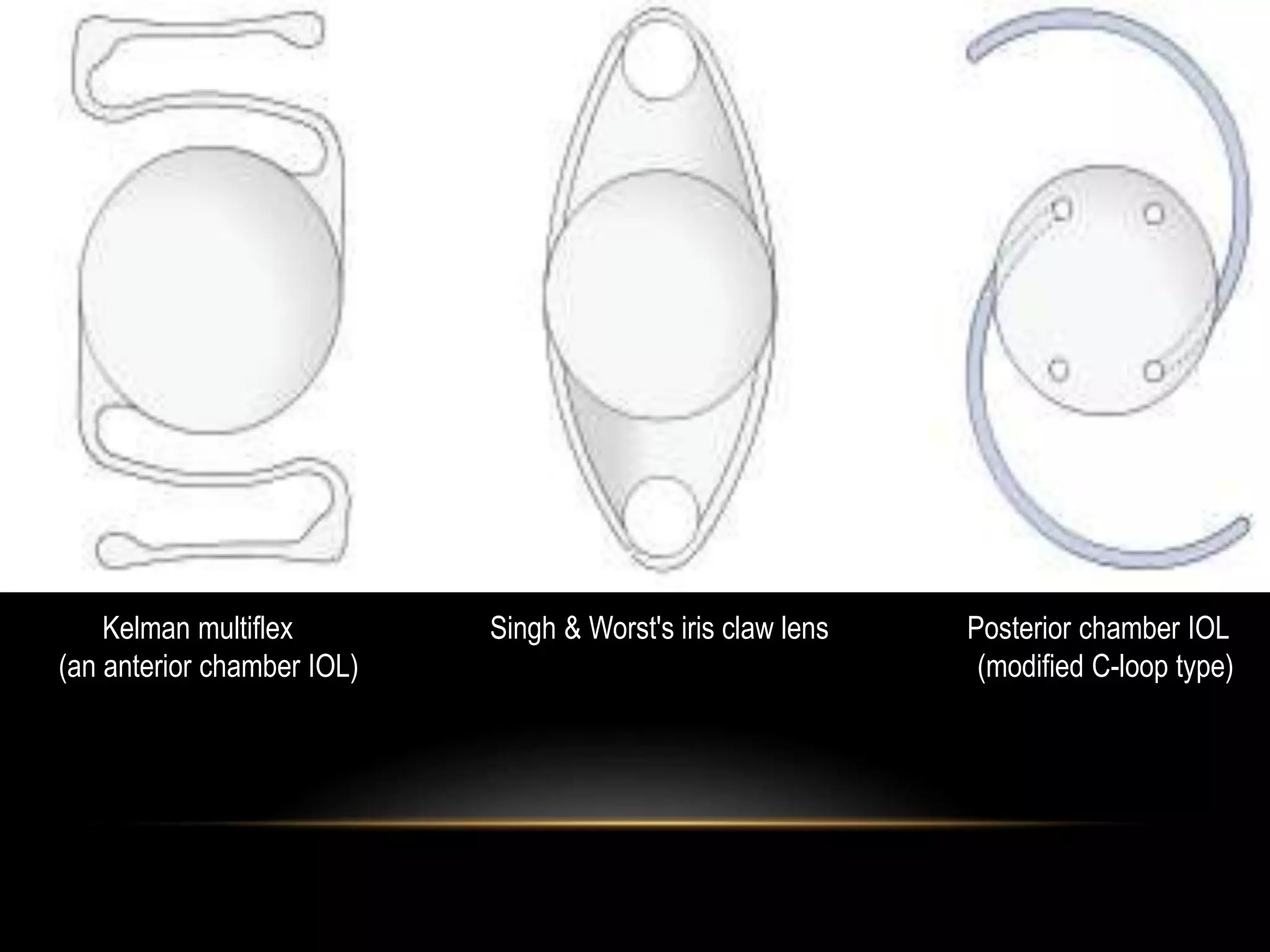 Management of Cataract | PPTX