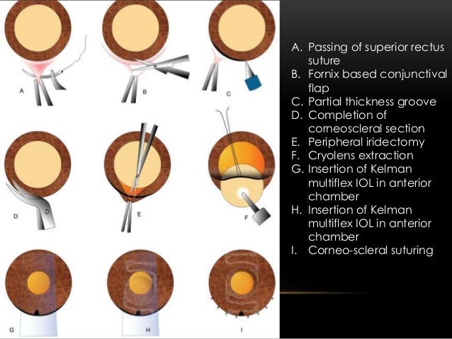 Management of Cataract