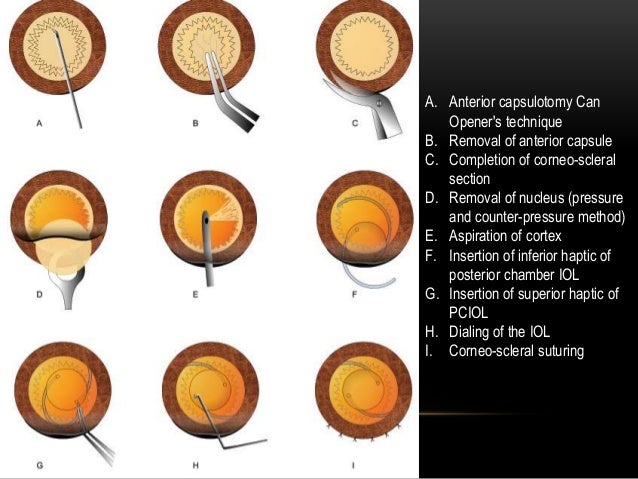 Management of Cataract