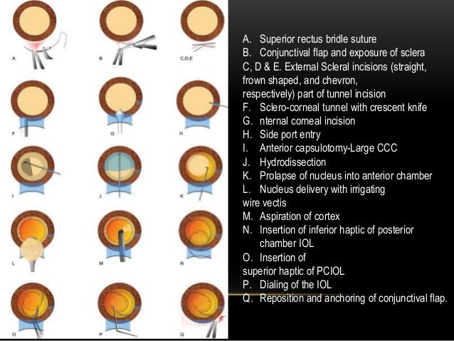 Management of Cataract